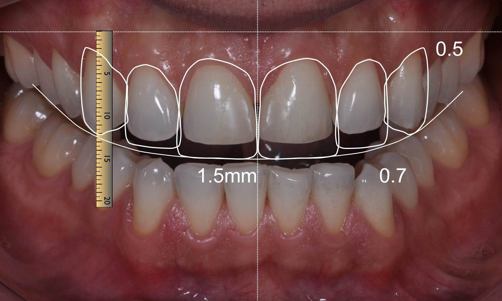 Правильные Передние Зубы Фото — Mixyfotos.ru