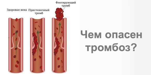 Чем опасен тромбоз и причины его возникновения