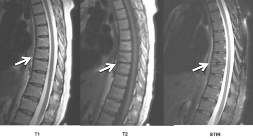 Modic МРТ: классификация изменений в позвоночнике | Клиника Доктора ...