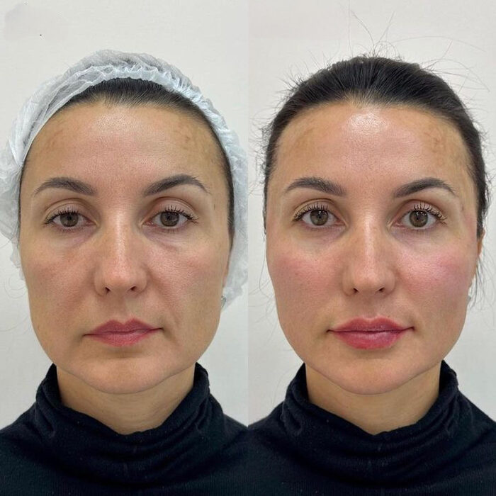 SMAS-лифтинг Ultraformer MPT в Казани | L.R. CLINIC