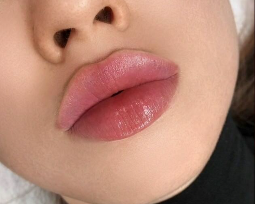 Lip Injections, Lip Fillers Toronto, Canada | Perfection Laboratory