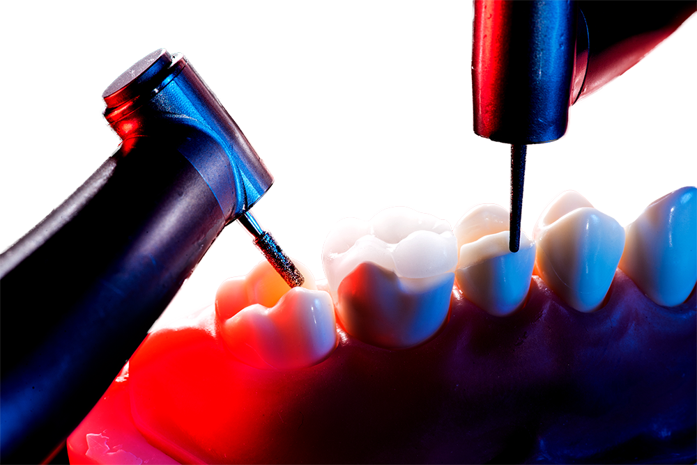 Ceramic in-lays, over-lays and veneer lays. Preparation designs.