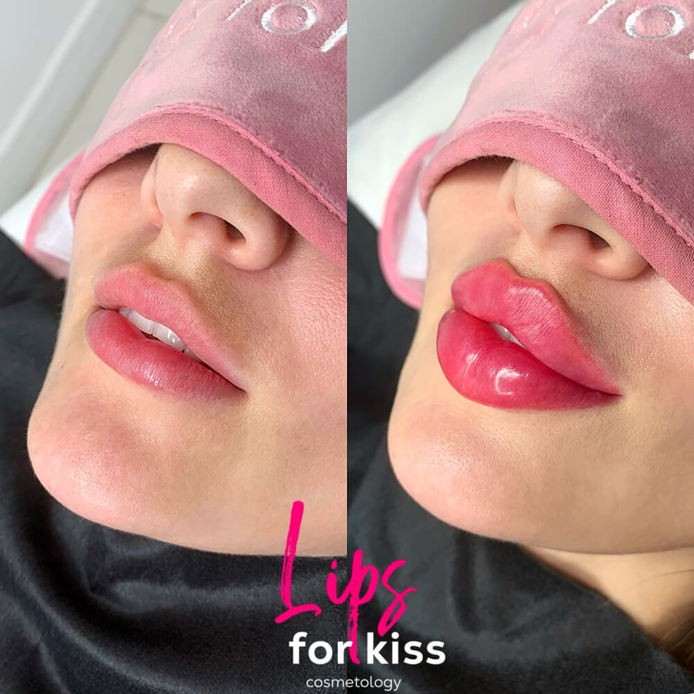 Master the Russian Lips Technique for a Perfect, Natural-Looking Pout