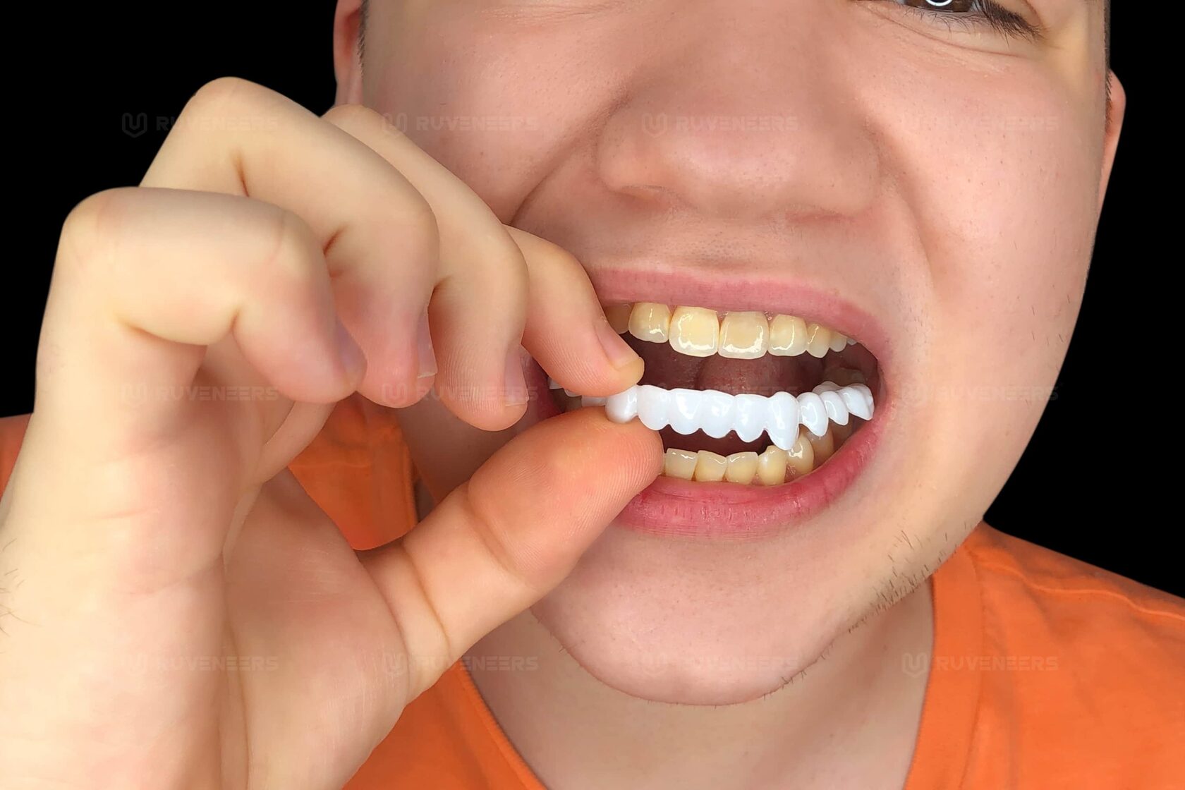 Care and use of individual removable veneers | RUVENEERS