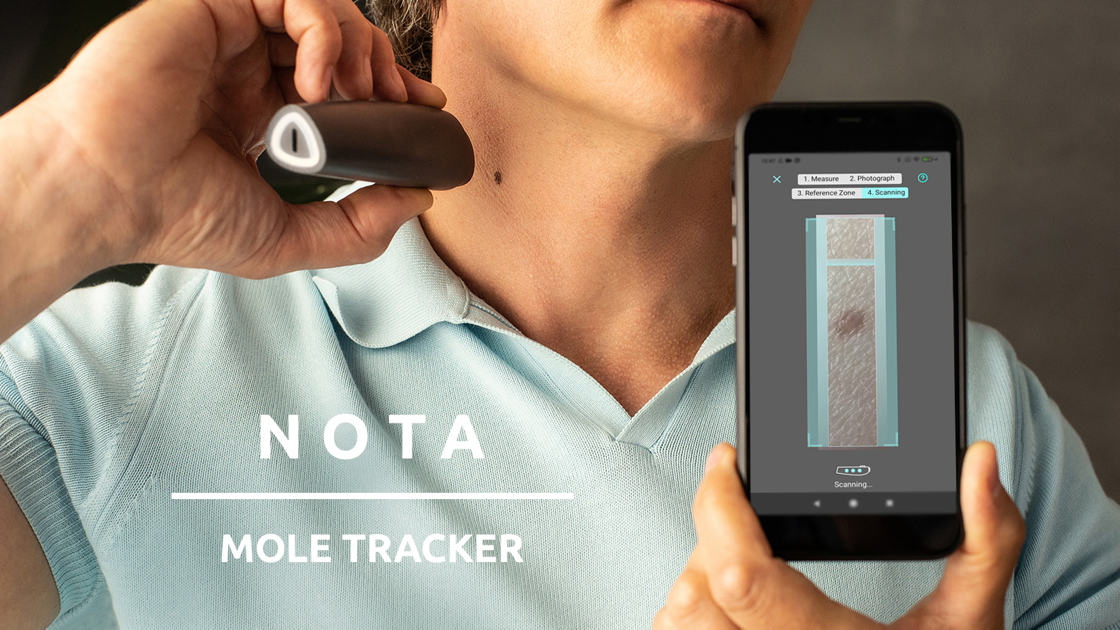 Familial Atypical Multiple Mole Melanoma