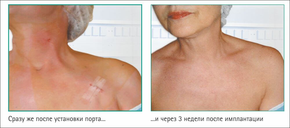 Порт-система Celsite: виды, преимущества и советы по выбору