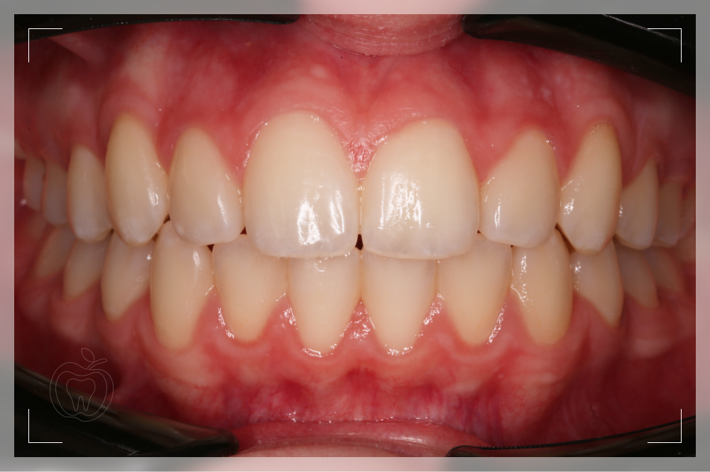 Коррекция неправильного положения и соотношения зубов (коррекция ...