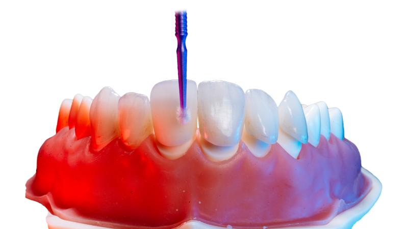 Bonding of ceramic veneers. Step-by-step protocols.