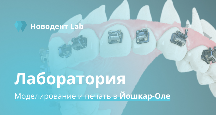 Цифровая лаборатория | Цифровая каппа для непрямой фиксации брекетов