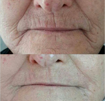 Купить аппарат холодной плазмы для косметологии и личного использования.