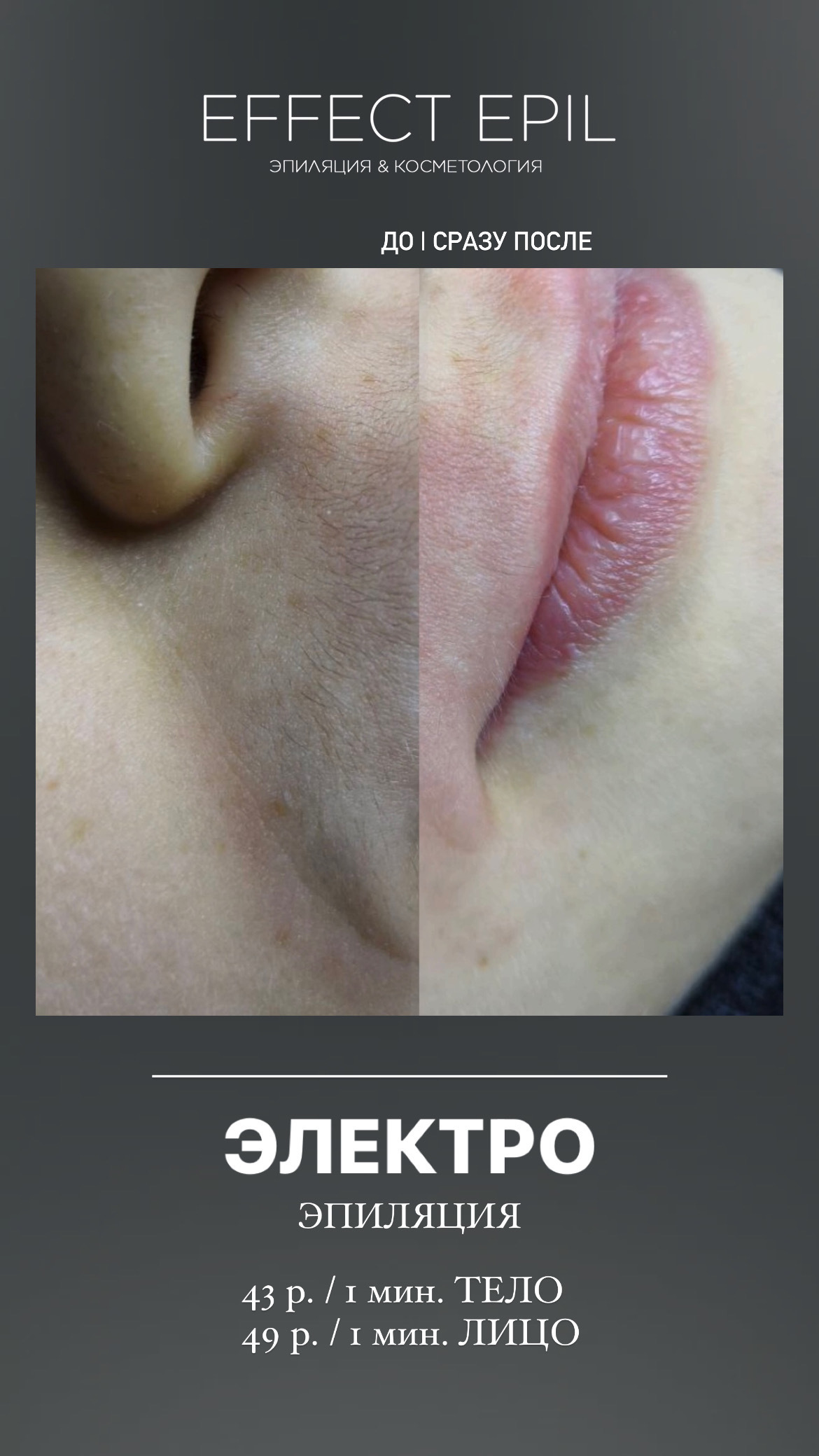 Электроэпиляция в Москве в клинике Effect Epil