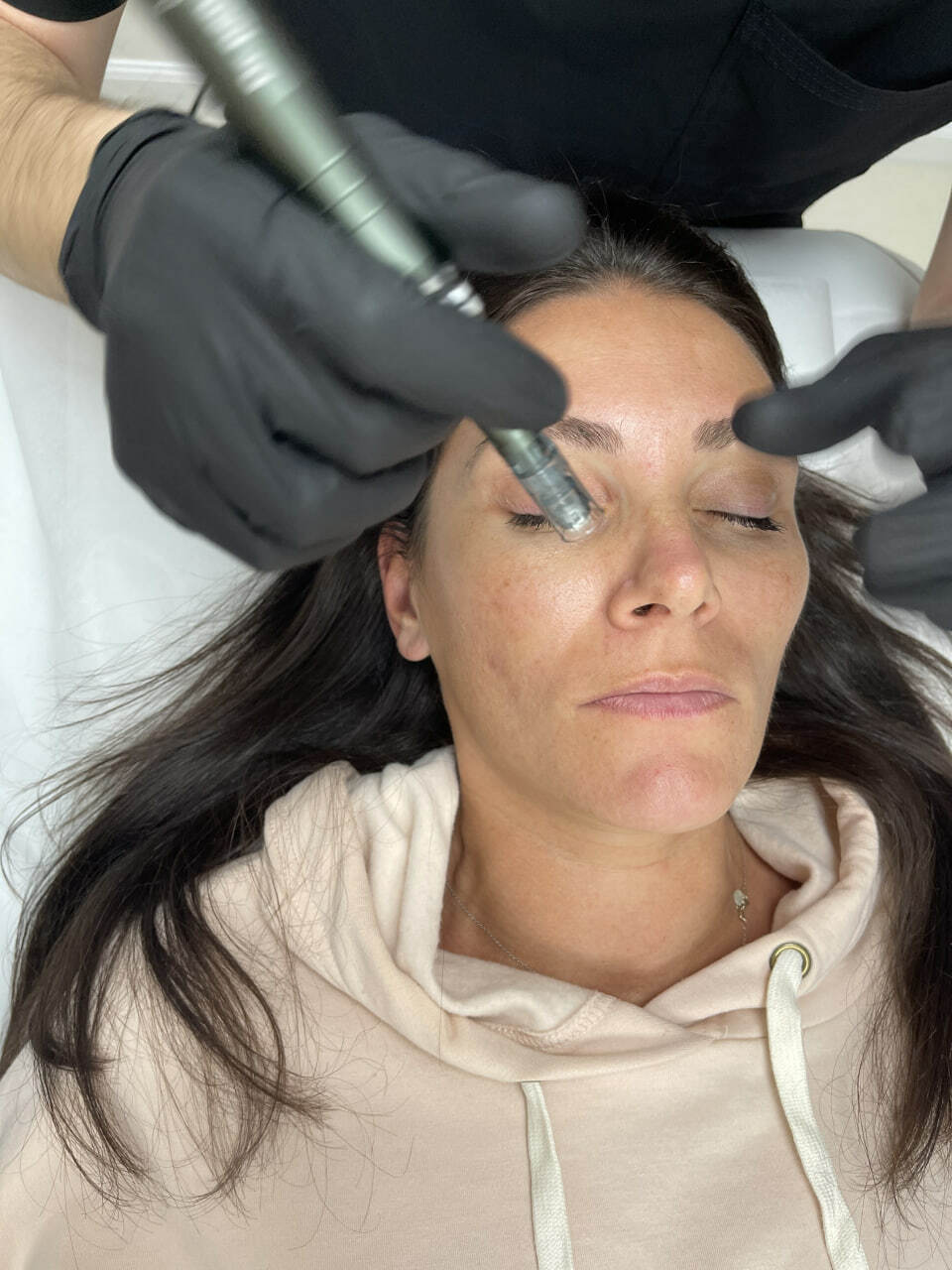 Microneedling Under Eyes: The Ultimate Solution at Borsalo Med Spa Microneedling Under Eyes: The Ultimate Solution at Borsalo Med Spa