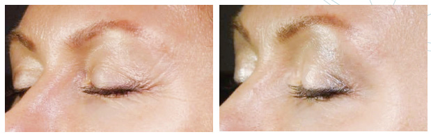 Aquashine BTX