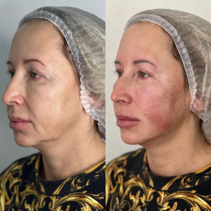 SMAS-лифтинг Ultraformer MPT в Казани | L.R. CLINIC