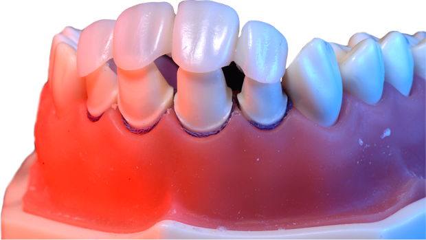 Temporary restorations: veneers, crowns, onlays. Online master-class ...