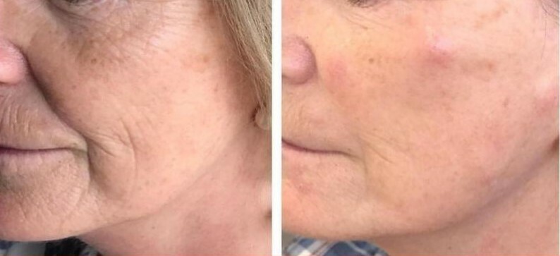 PROFHILO Fantastic Skin Hydration