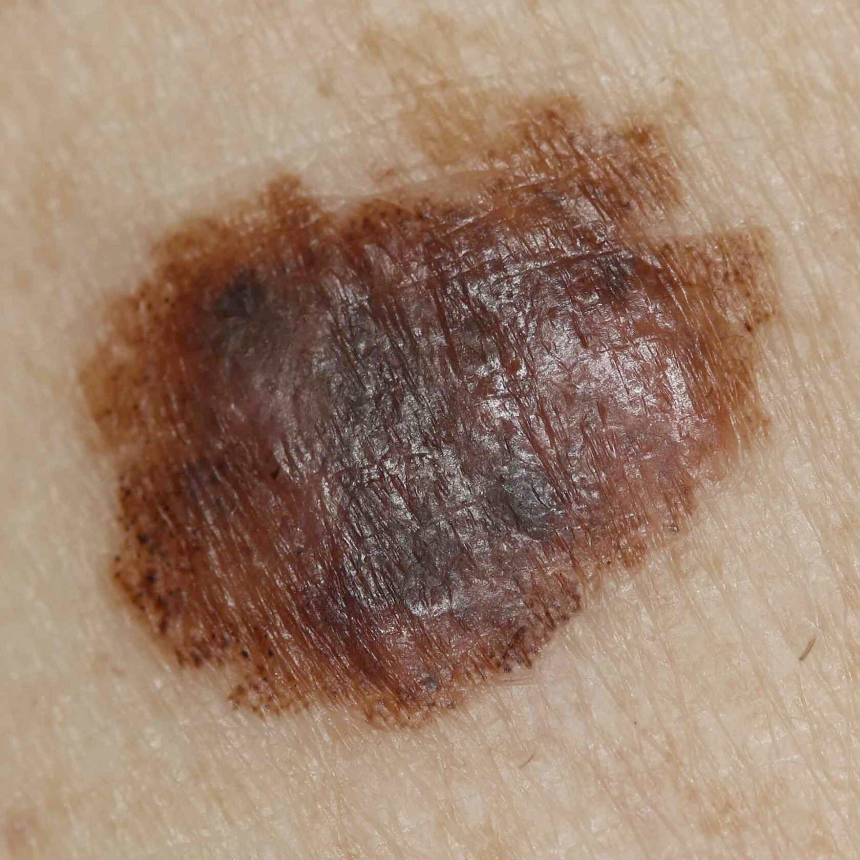 For melanoma, skin color is unimportant