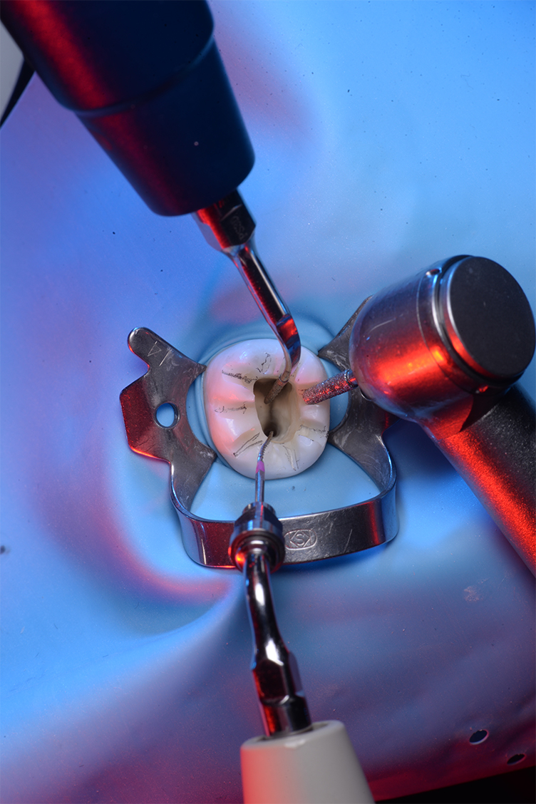 Endodontic access: straight line VS micro. Step-by-step guide