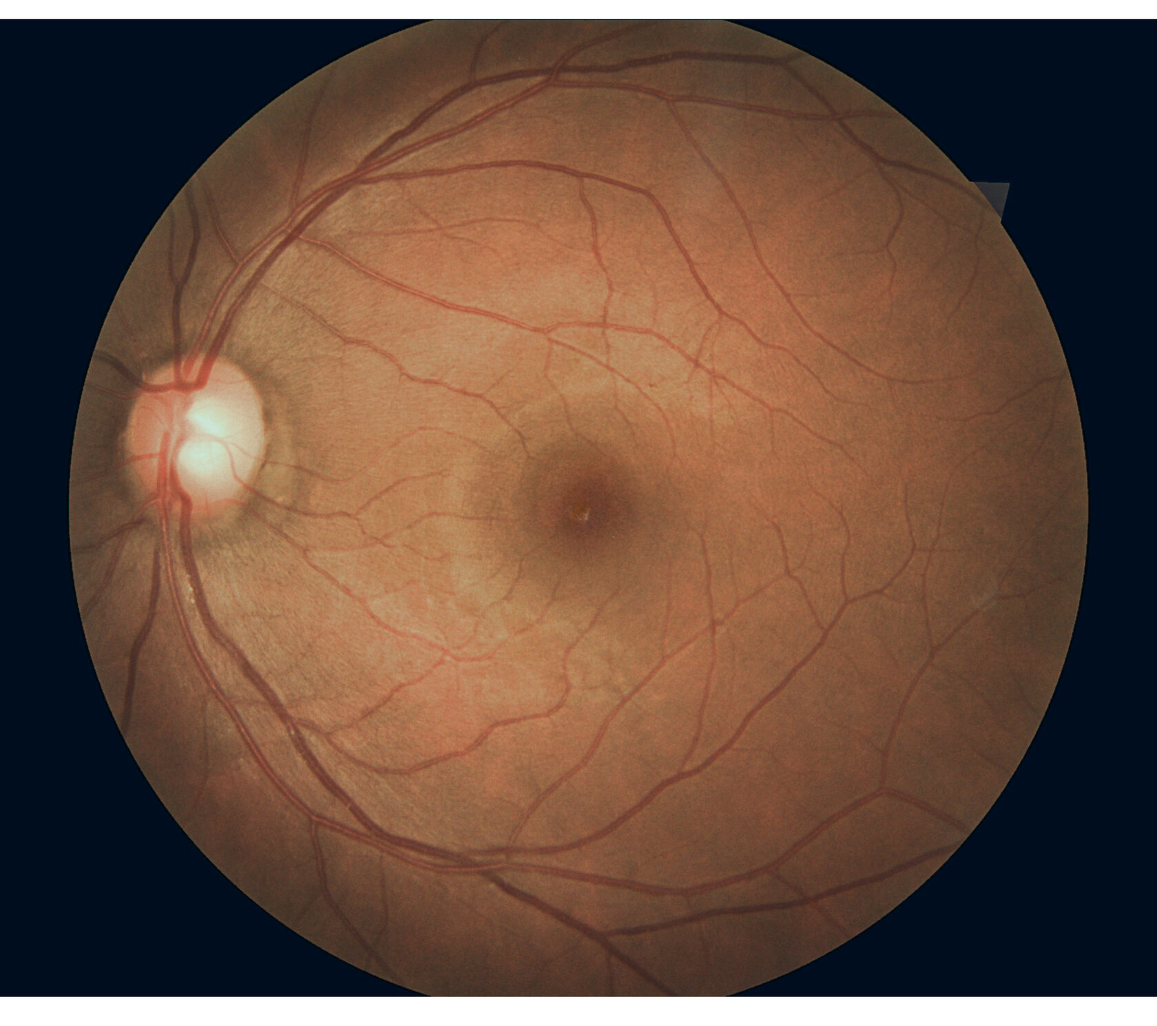 Diabetic Retinopathy Detection