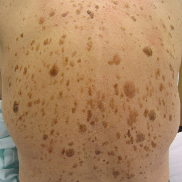 Keratoma: symptoms, treatment, prevention