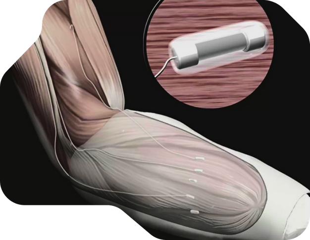 Human Enhancement Devices - The next level Prosthetic Hand | Esper Bionics