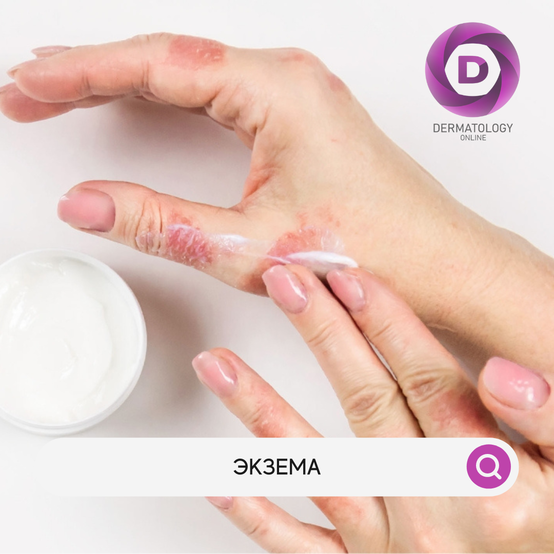 Экзема симптомы причины лечение виды как бороться