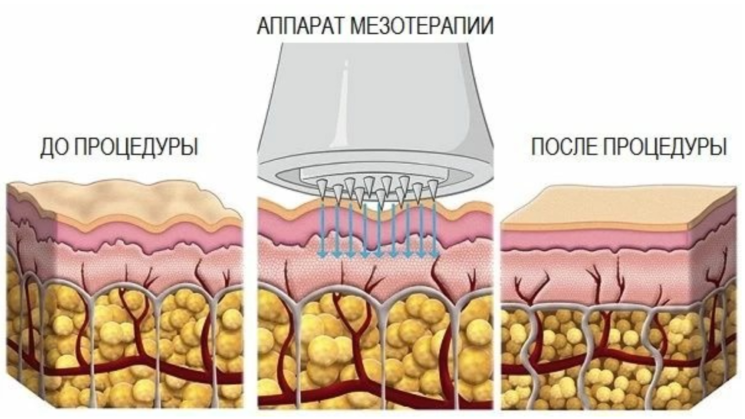 Мезотерапия для лица – оздоровление, профилактика старения в клинике ...