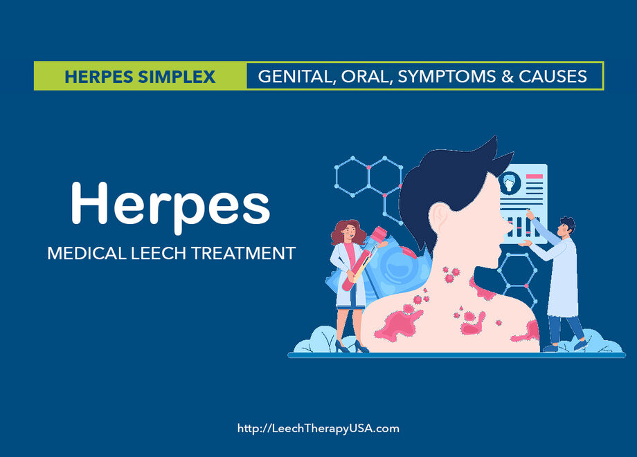 Herpes treatment by Medicinal Leeches in Philadelphia, PA
