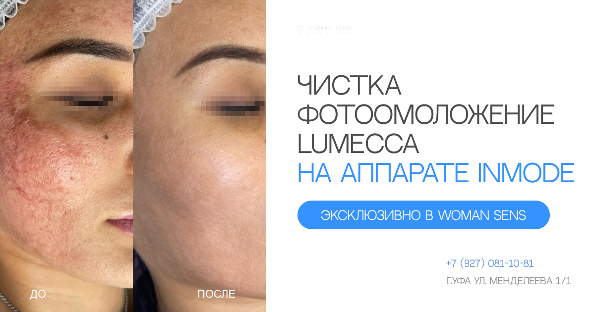 Чистка фотоомоложение Lumecca на аппарате INMODE - Woman Sens Уфа