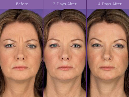 BOTOX (VISTABEL, AZZALURE)