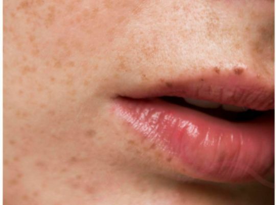 Фотодинамическая терапия HELEO4 PRO LED