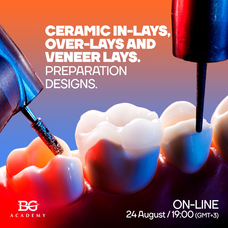 Ceramic in-lays, over-lays and veneer lays. Preparation designs.