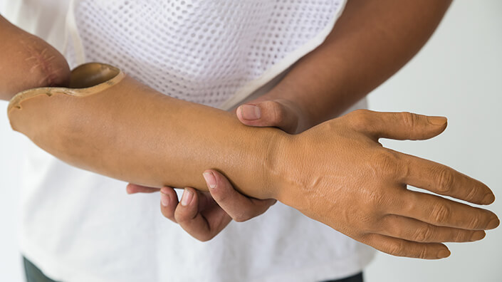 How To Choose a Prosthetic Arm