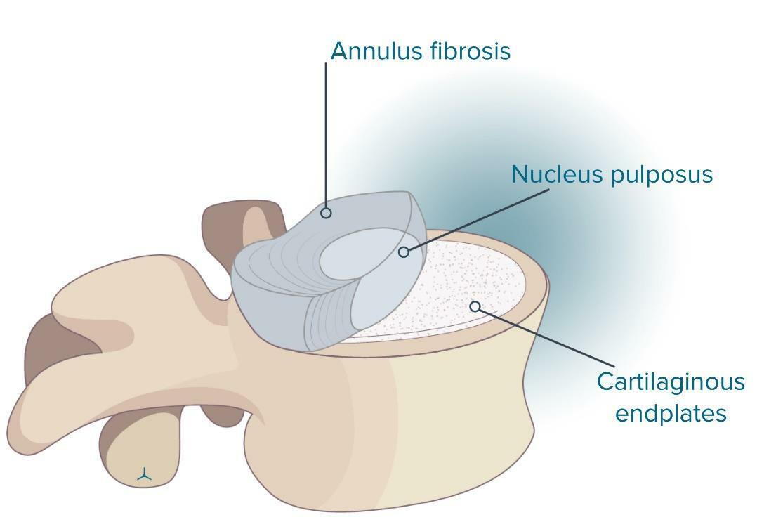 Herniated Disc: Symptoms, Causes & Treatment Options