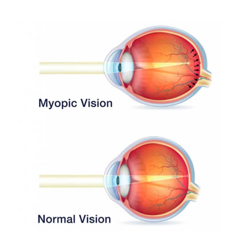 Myopia management