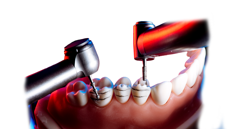 Veneers on premolars and molars. Clinical aspects of tooth preparations.