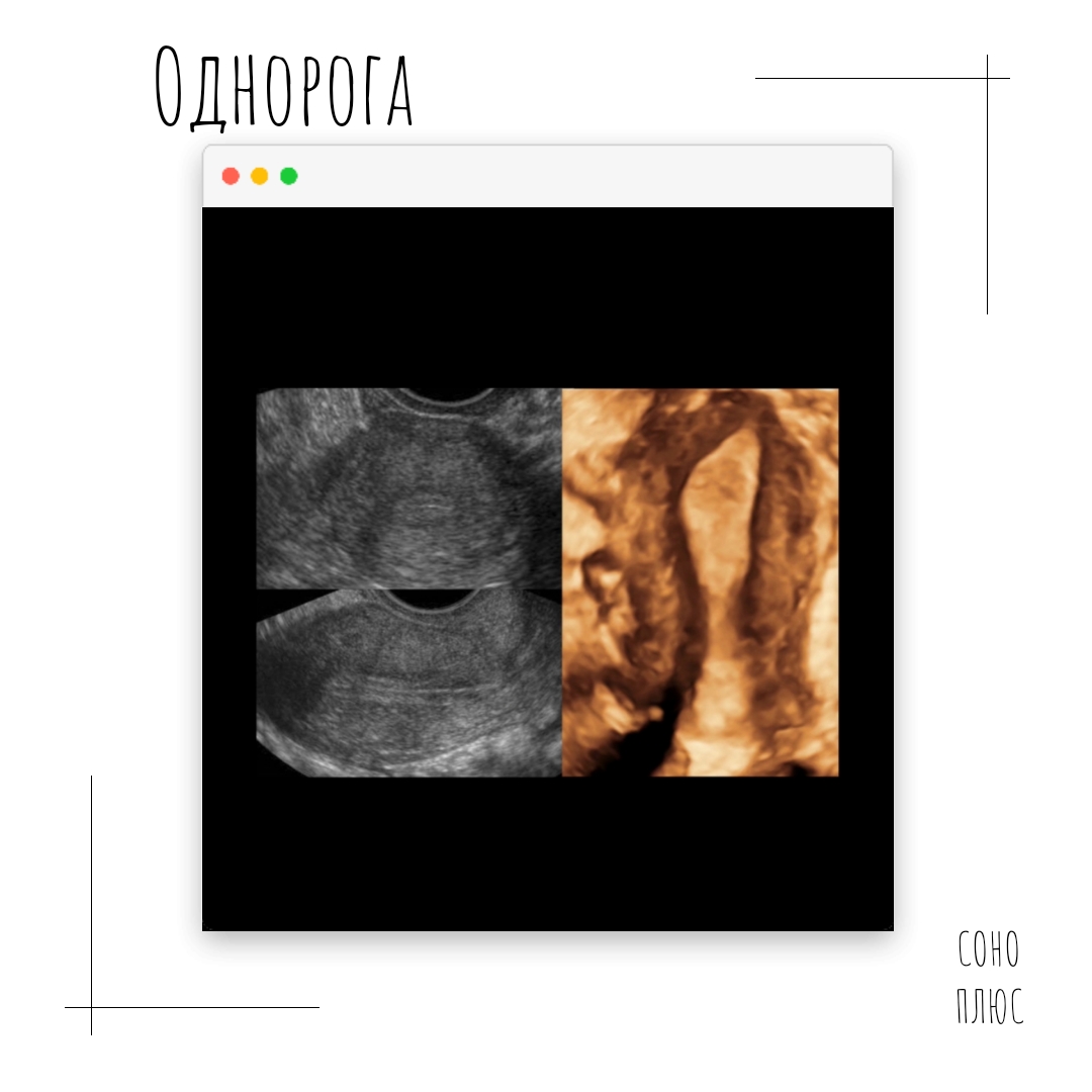 Аномалії будови матки