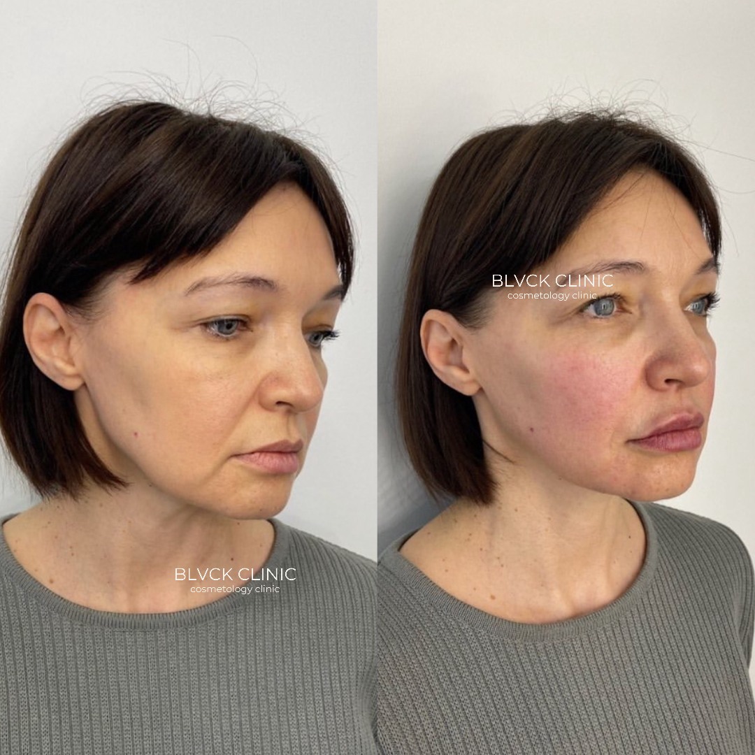 Подтяжка лица SMAS-лифтинг Ulthera в Санкт-Петербурге