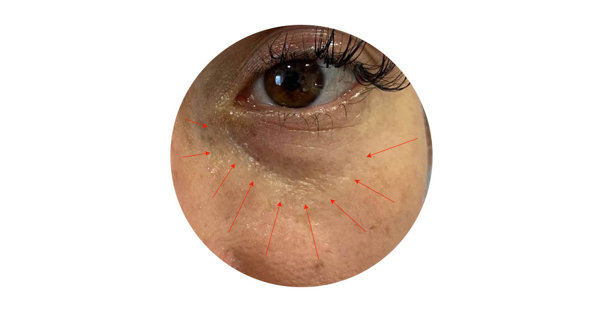 Ojeras negras bajo los ojos ¿cómo deshacerse de ellas?