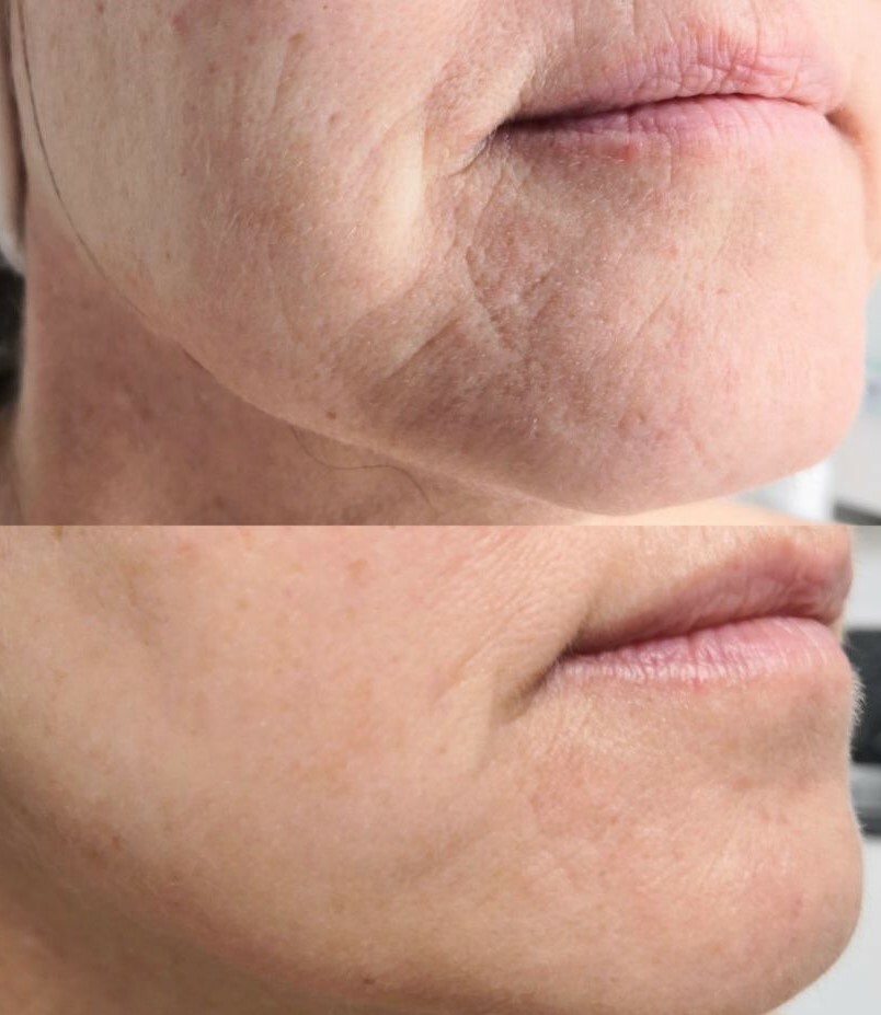 RF Radio Frequency face lifting treatment in Hallandale, Miami, Fort ...