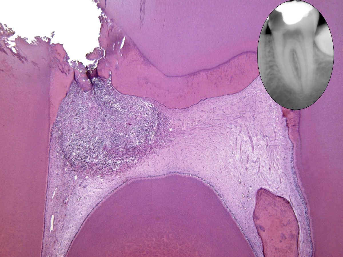 Update in endo 2021 by Domenico Ricucci