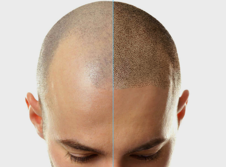 Пересадка Волос в Москве Цена Фикс.80-157 тыс.руб. Без боли. За 1 день ...