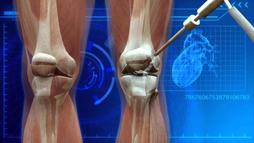 Артроскопия