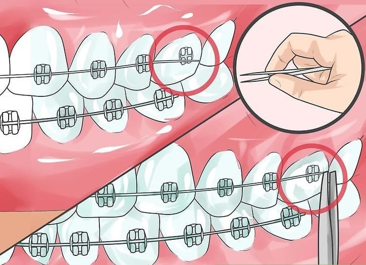 Cómo insertar el arco en el bracket en casa