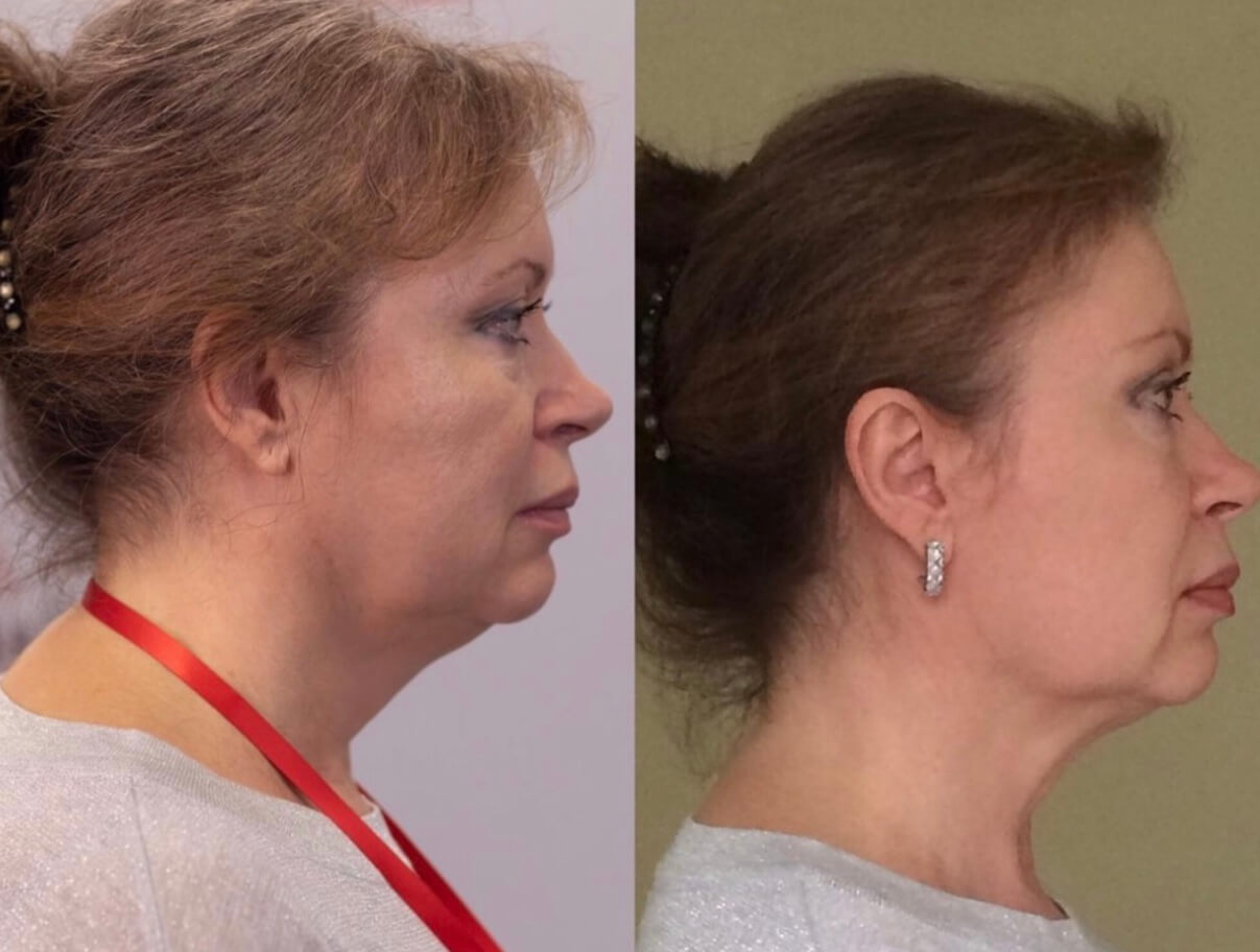 Look 5-10 years younger after taking my Face Fitness courses.