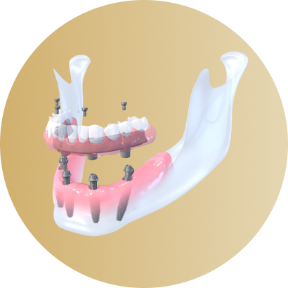 Восстановление при полной адентии запатентованной системой STRAUMANN ...