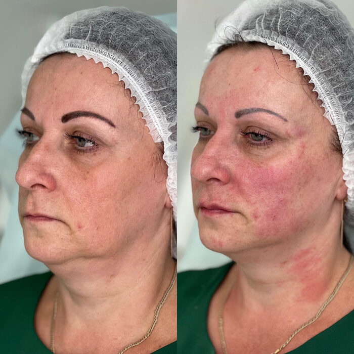 SMAS-лифтинг Ultraformer MPT в Казани | L.R. CLINIC