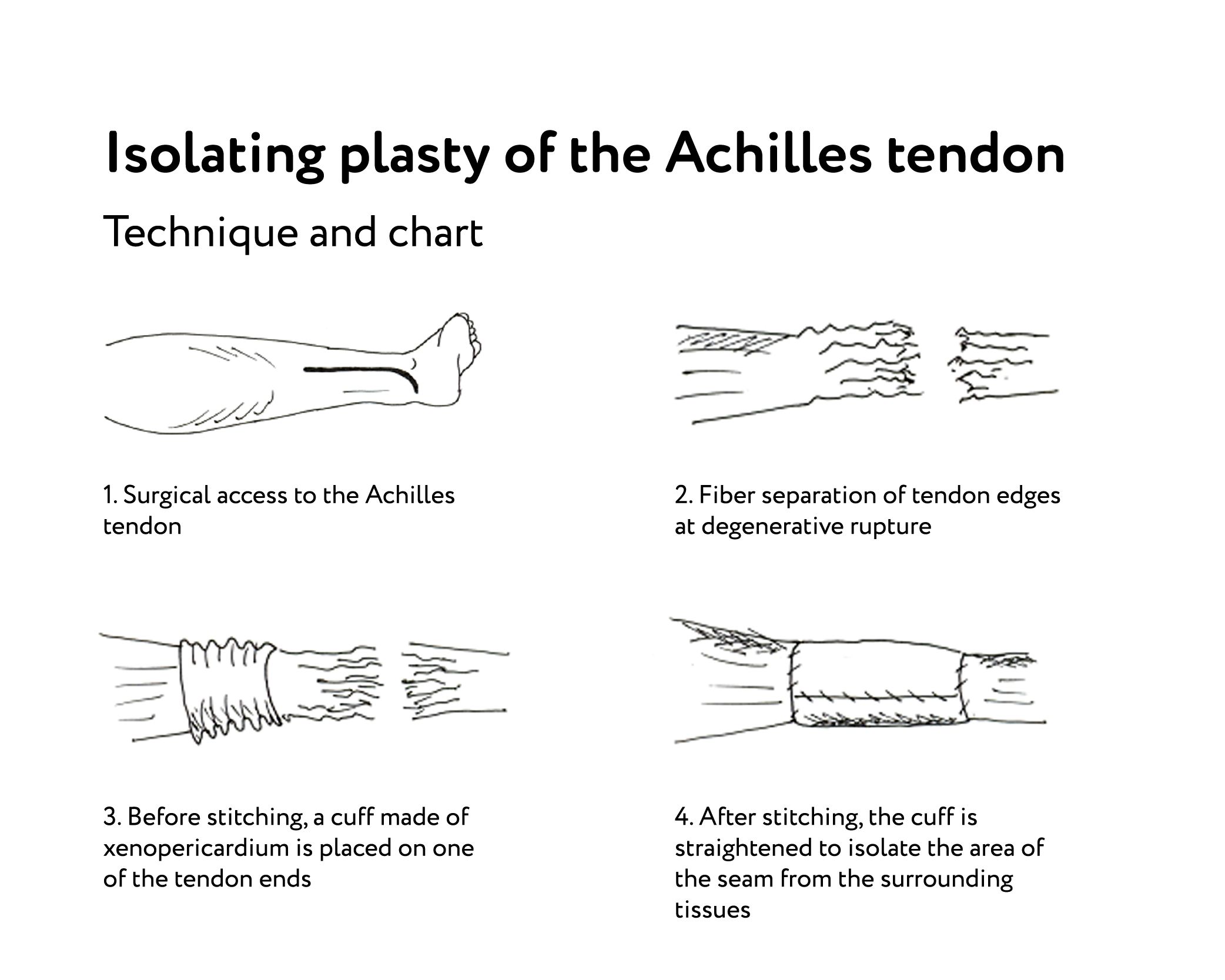 Biomaterial for insulating plasty of large tendons