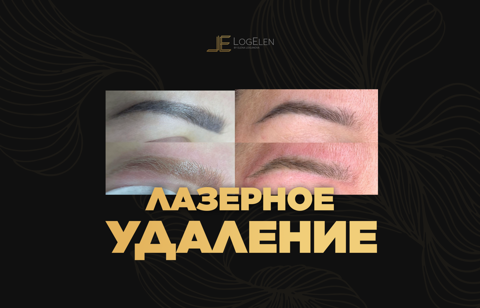 Удаление некачественного татуажа или татуировки