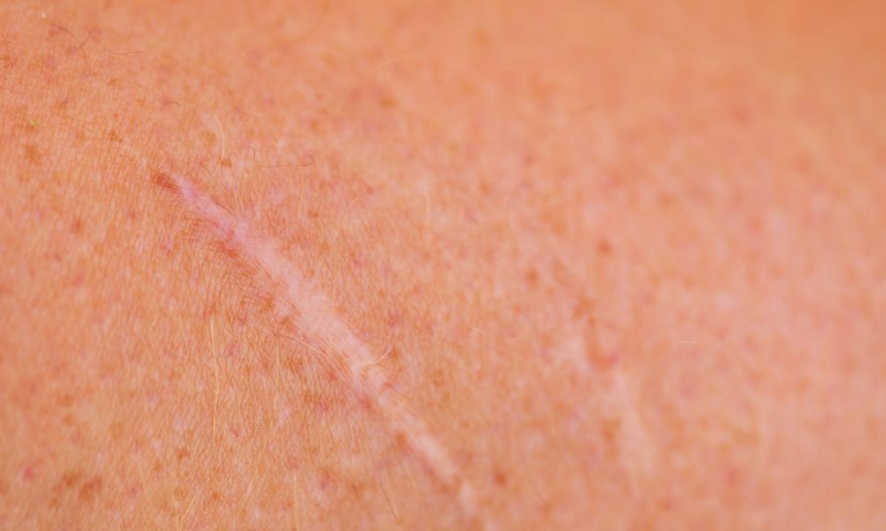 Linear Scar Management Phases for Optimal Healing & Outcomes